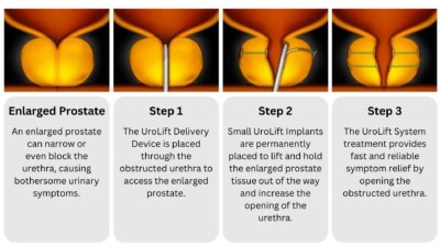 UroLift