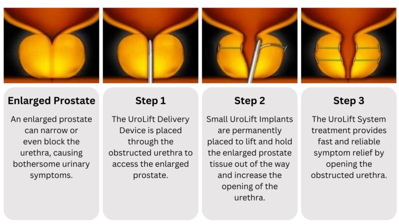 UroLift